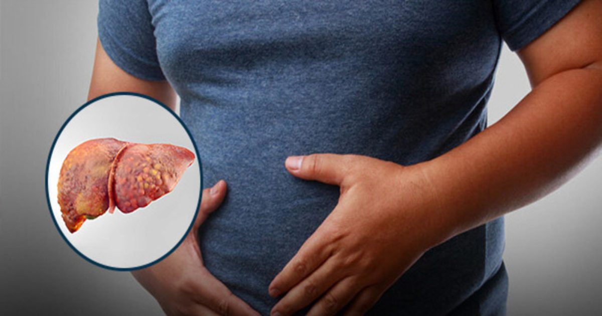 Fatty Liver: ਕਿਵੇਂ ਹੁੰਦਾ ਹੈ ਫੈਟੀ ਲੀਵਰ, ਡਾ. ਐਸ.ਕੇ. Sarin ਨੇ ਦੱਸੇ ਸੰਕੇਤ ...