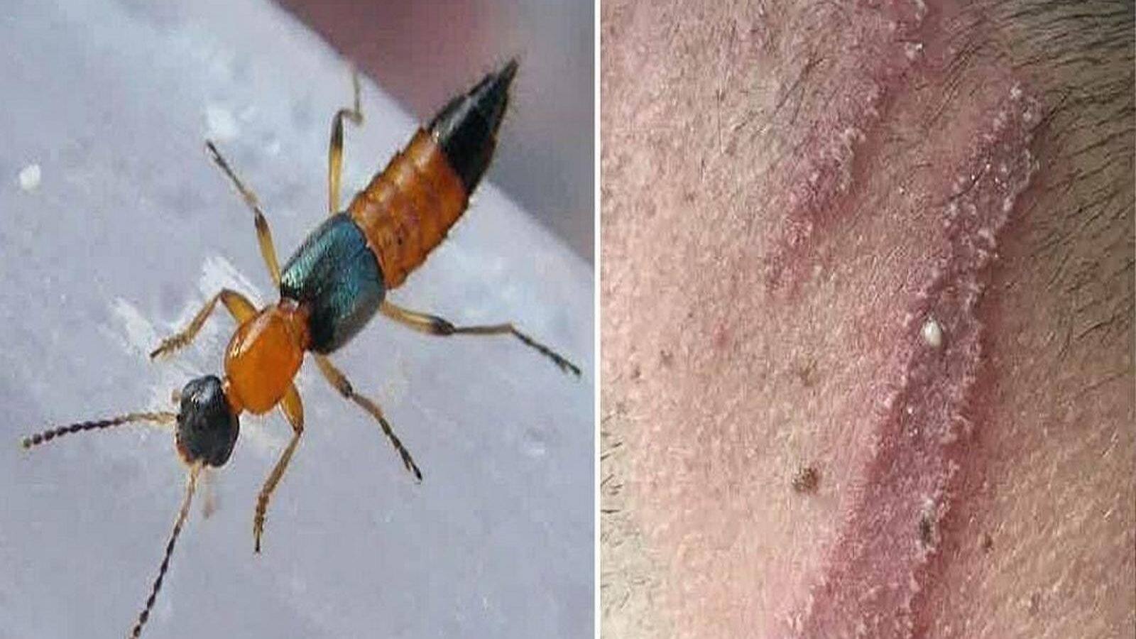 What is Nairobi Fly Nairobi Flies Burns Skin of Sikkim Students ...