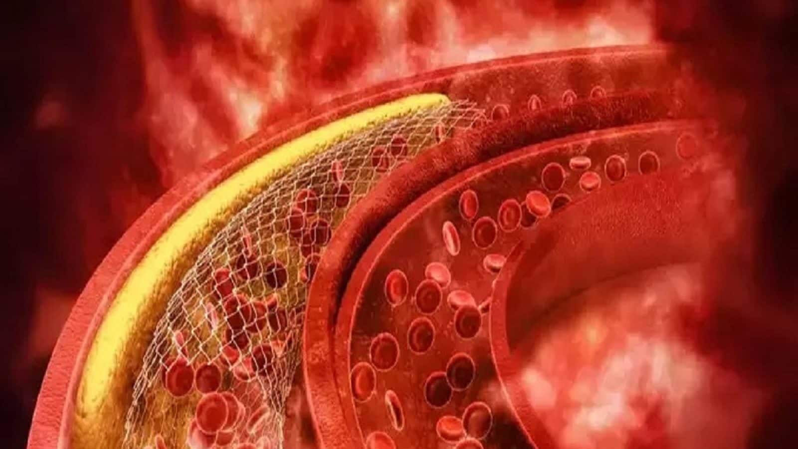 High Cholesterol Control Tips, Bad Cholestrol Control Tips, Health Tips ...