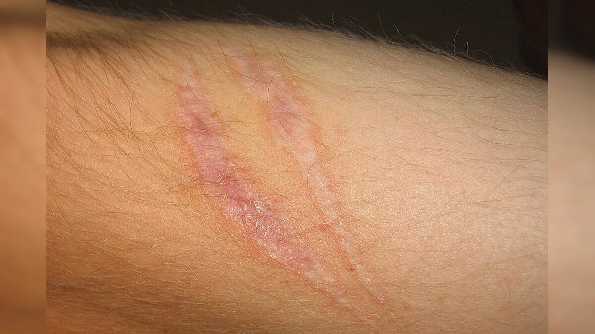 wounds। scars। cuts। scratch। natural healing elements। wound care ...