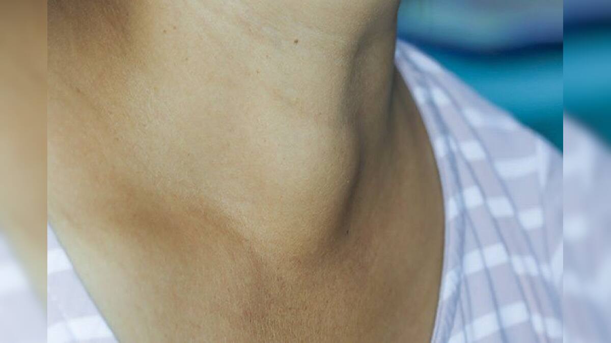 Thyroid Cancer Symptoms ঘাড়ে একটা ছোট্ট মাংসপিণ্ড থেকে ধরা পড়ে