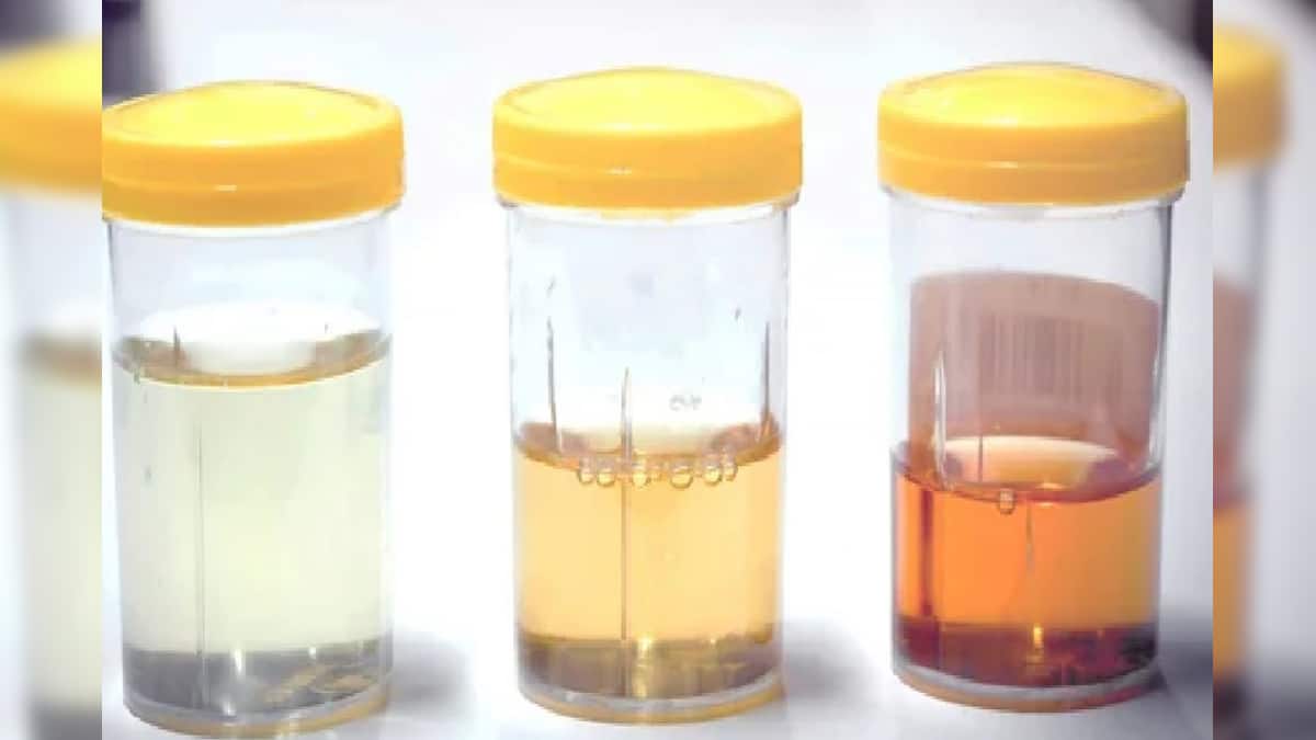 abnormal color of urine may sign of serious health problem, প্রস্রাবের ...