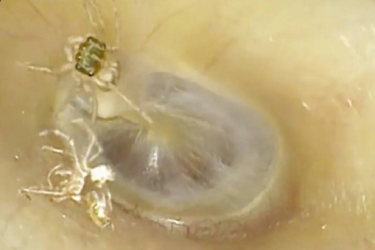 spider in the ear of taiwan woman, এক বৃদ্ধার কানের ভিতর থেকে মাকড়শা ...