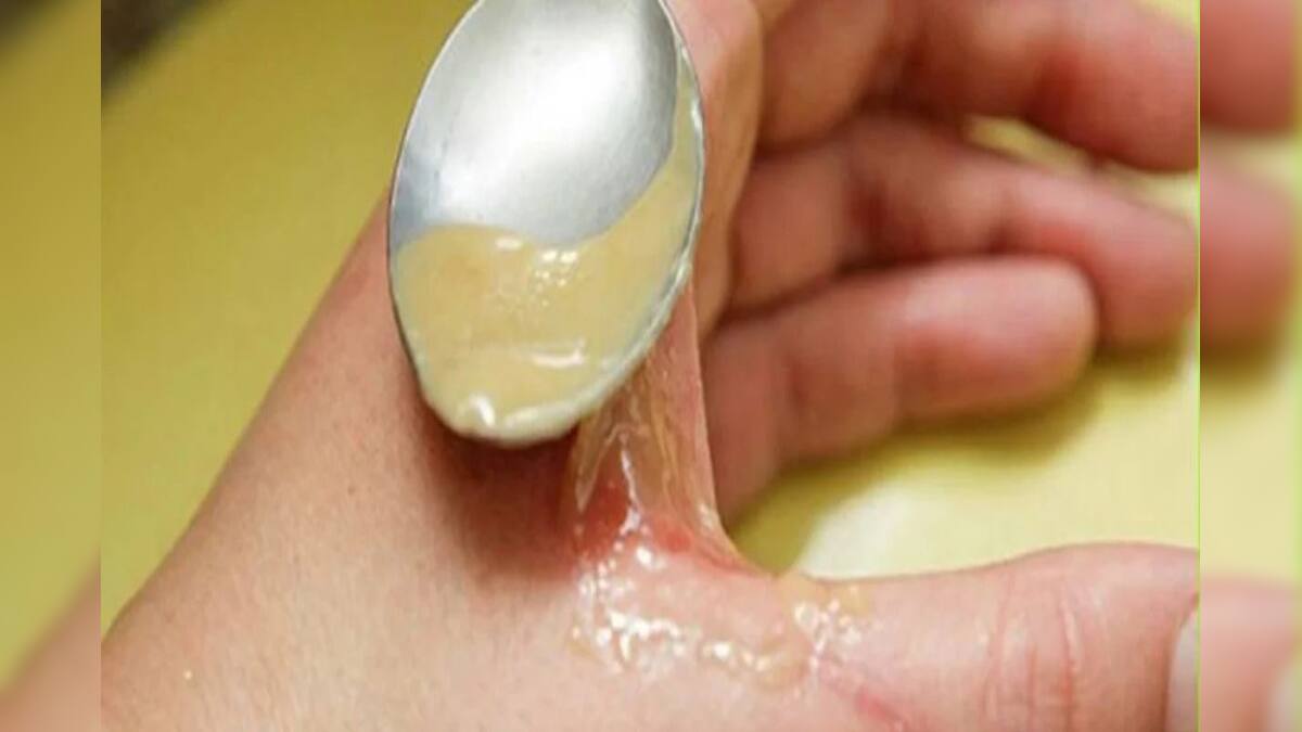 Burn Tips: রান্না করতে গিয়ে হাতে গরম তেল...? ফোস্কা...? ভুলেও বরফ ...