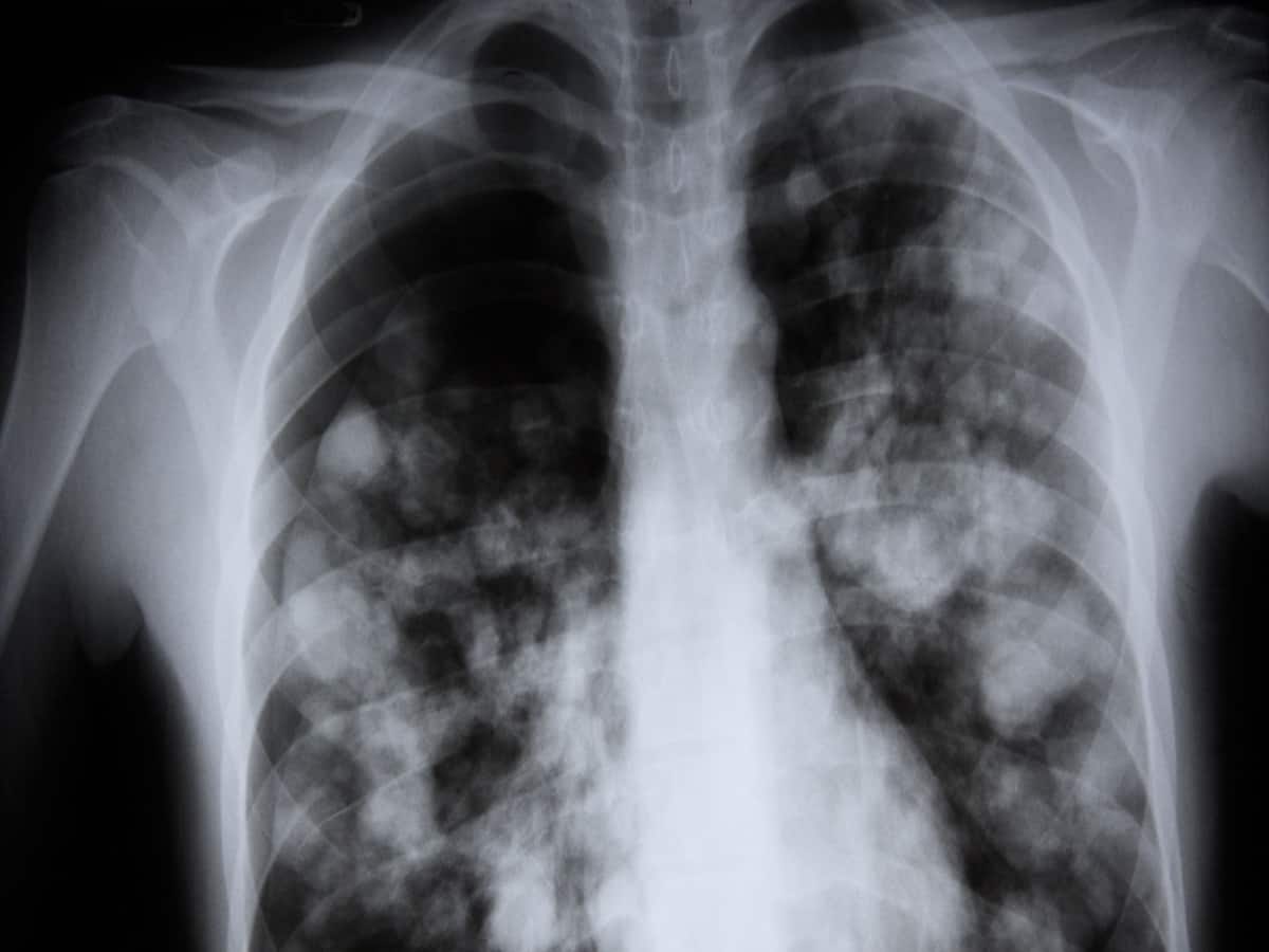 White Lung Syndrome:'চিনা নিউমোনিয়া'-র মধ্যেই আর এক রহস্যময় রোগ ...