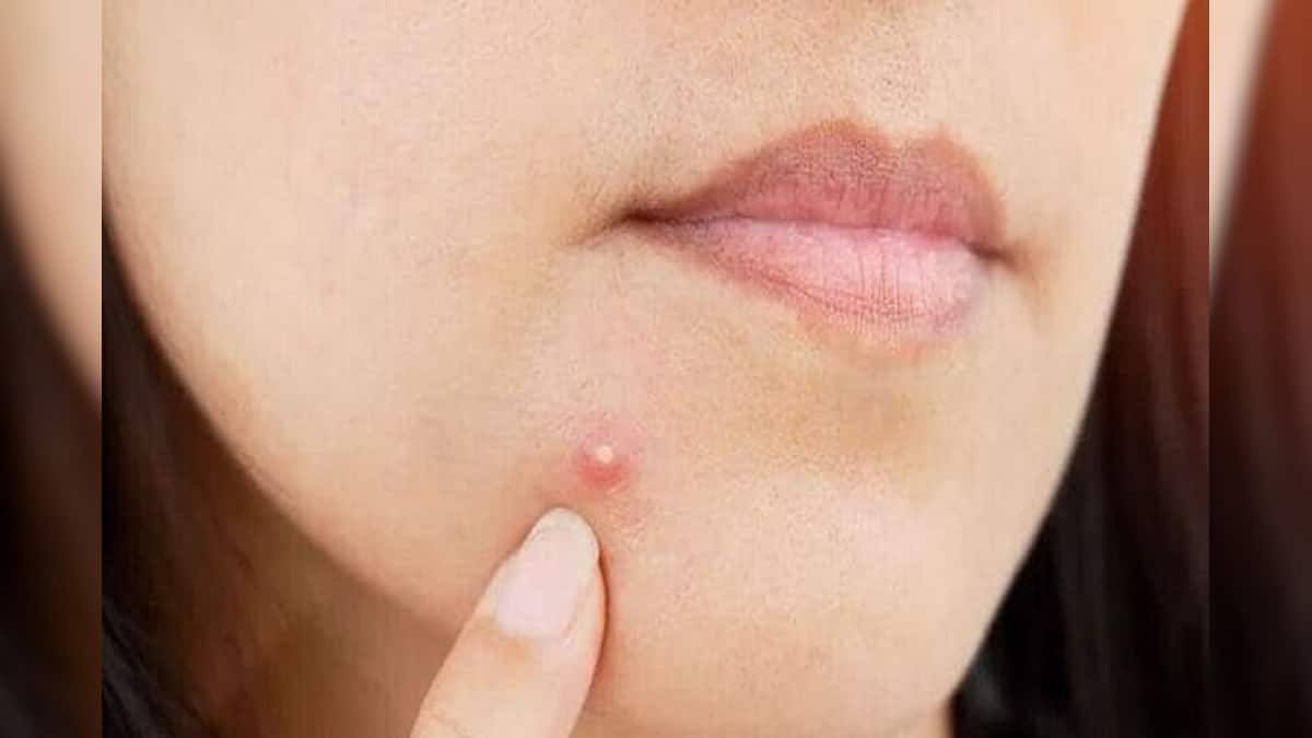 Boil Treatment: ফোঁড়ার ব্যথায় কাবু! বাড়িতেই করুন এই সহজ কাজ! দু'দিনে ...