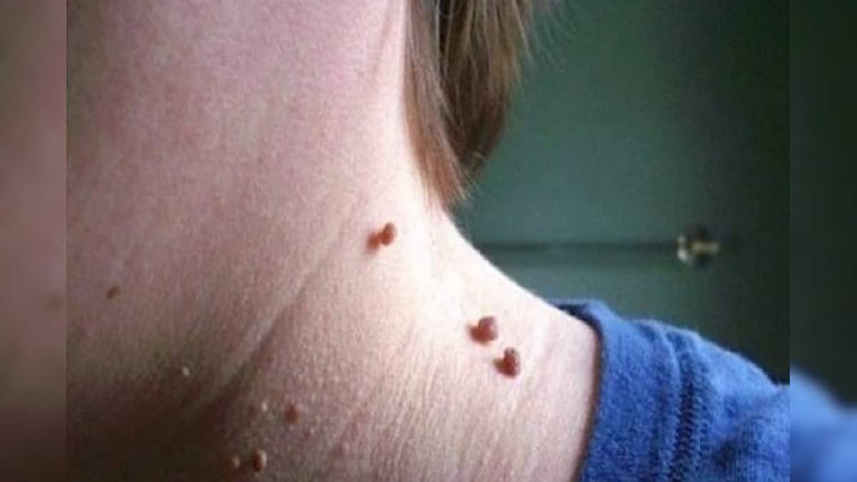 Wart Problem on Skin আপনার শরীরে আঁচিল আছে? আঁচিল কেন হয় জানেন ...