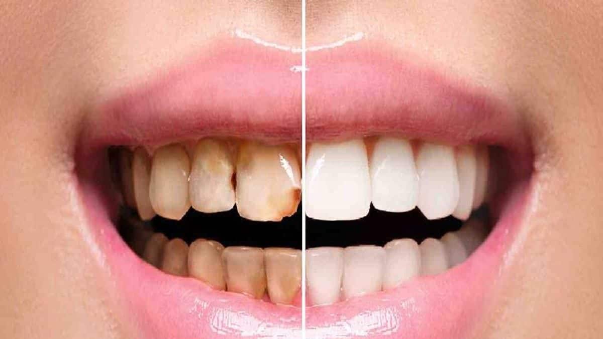 Teeth Cavity Remedies: আপনার রান্নাঘরেই আছে এই ব্রহ্মাস্ত্র! নিয়ম মেনে ...