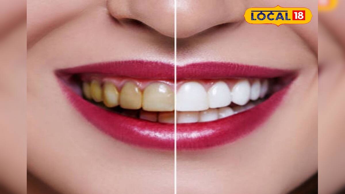 Tooth Care | দাঁতে হলদে ছোপ, হারিয়েছে ঔজ্জ্বল্য! একটা কলা দিয়ে ঝকঝকে ...