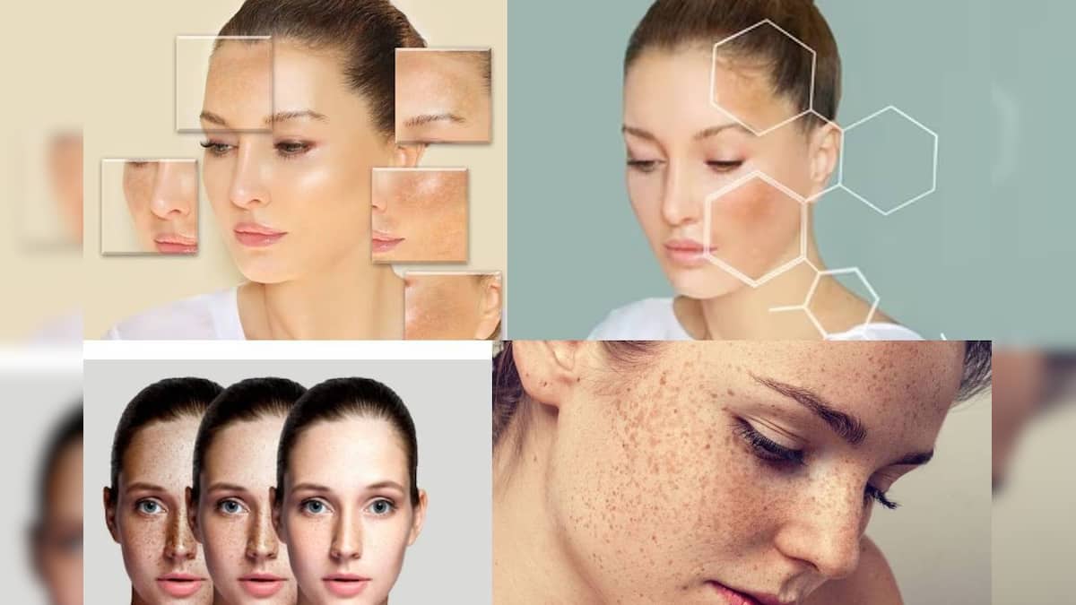 Dark Skin or Hyperpigmentation: কোন ভিটামিনের অভাবে চামড়া কালো হয়ে যায়? ত্বকে পড়ে কালচে ছোপ ...