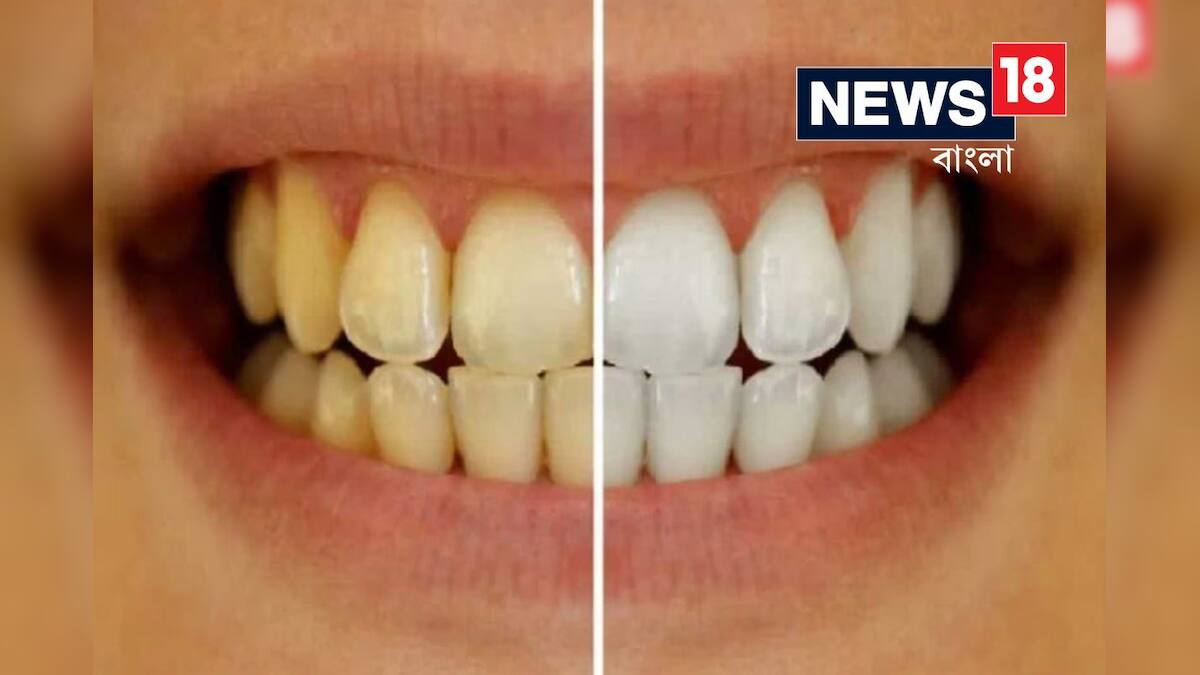 Teeth care: হাসতে গিয়েও থমকে যান? ঘরোয়া টোটকায় দাঁত হবে মুক্তোর মতো ...