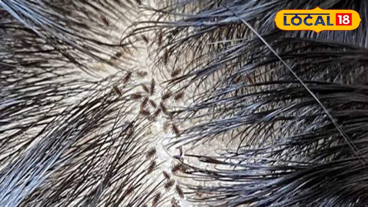 Lice Treatment: উকুন দূর হবে রাতারাতি! ক্ষতি হবে না চুলের! চিকিৎসকের ...