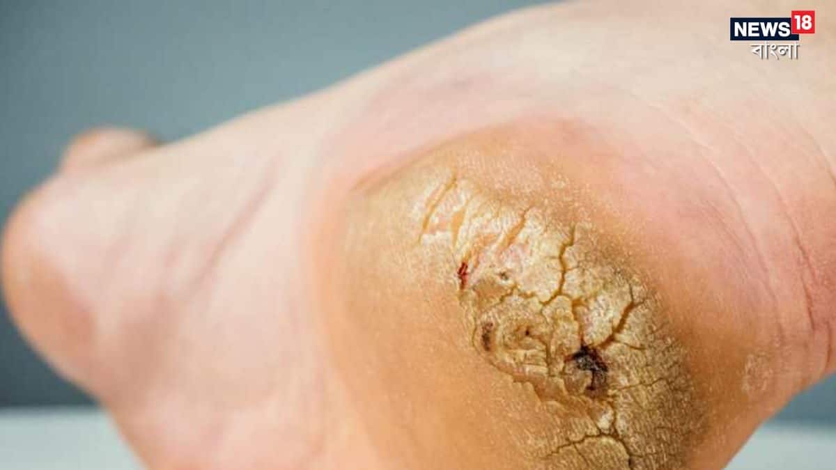 How to heal cracked heels: একরাতে উধাও ফাটা গোড়ালি! রোজ রাতে করুন একটি ...
