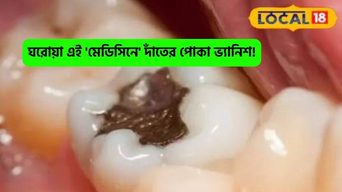 Tooth Cavity Care: সাদা দাঁতের মাঝে গর্ত করে বসে আছে 'পোকা'! ডেনটিস্টের ...