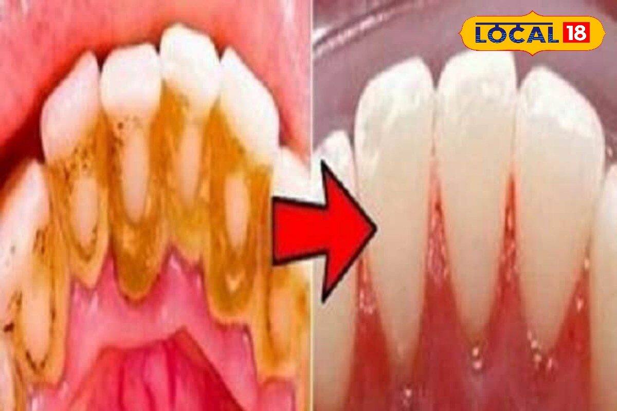 Whitening Teeth: মুখ খুলেই বেড়িয়ে পড়ে হলদেটে চর পড়া দাঁত? দামি ...