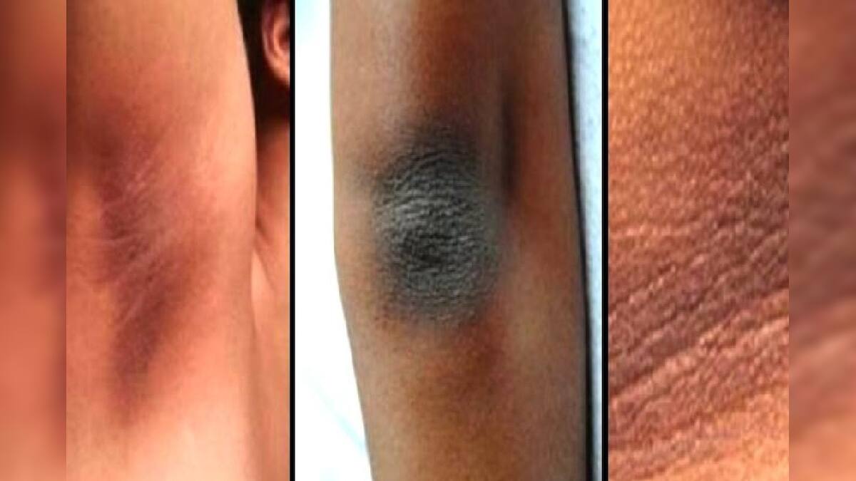 How to Remove Knee Under Arms Darkness: কনুই, হাঁটু, বাহুমূলের কালো ...