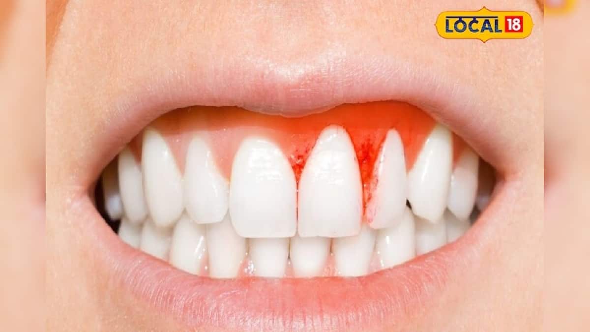 Tooth Care Tips: দাঁত মাজার সময় মাড়ি থেকে রক্ত ঝরছে? ঘরোয়া টোটকায় ...