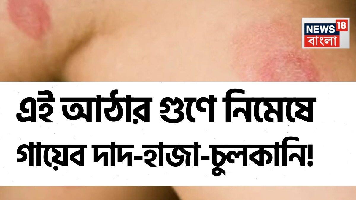 Monsoon Skin Disease: এক ফোঁটা আঠার কামাল! বর্ষায় নিমেষে সারবে দাদ ...