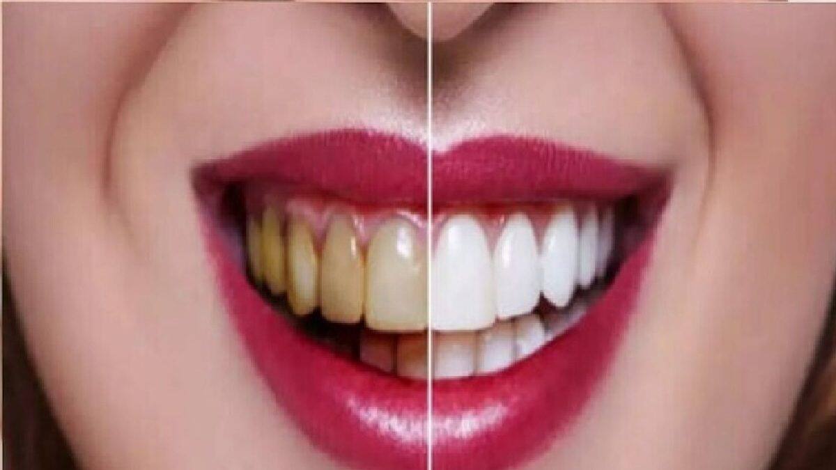 Yellow Teeth Problem Solve একে নোংরা-হলুদ দাঁত-তার উপর আবার পচা ...