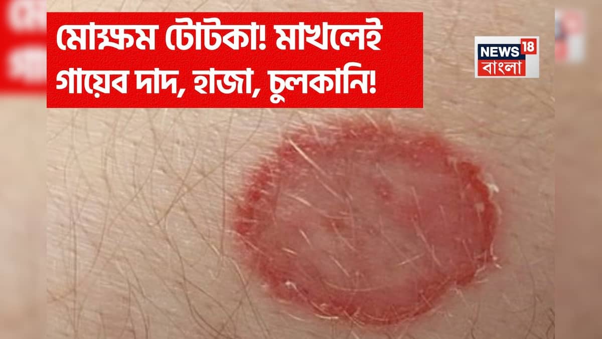 Skin Disease: নারকেল তেলে ‘এটা’ জাস্ট ১ চামচ মিশিয়ে গায়ে মাখলেই ...