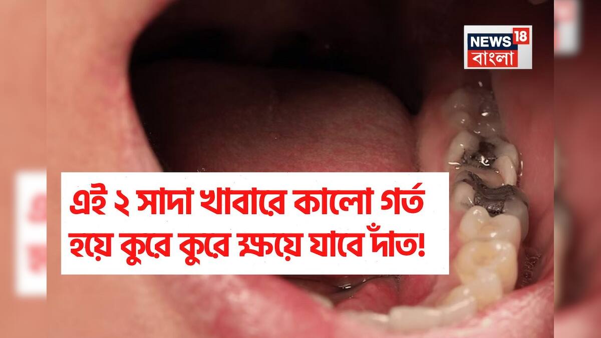 Food to Cause Tooth Cavity: ভুলেও মুখে দেবেন না এই ২ সাদা খাবার! কালো ...