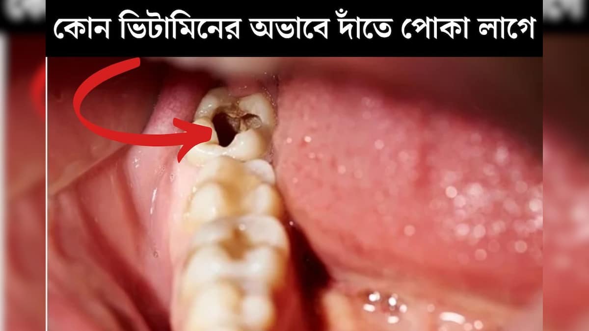 Tooth Cavity: কালো গর্ত, প্রবল যন্ত্রণা! দাঁতে পোকার সমস‍্যায় জেরবার ...