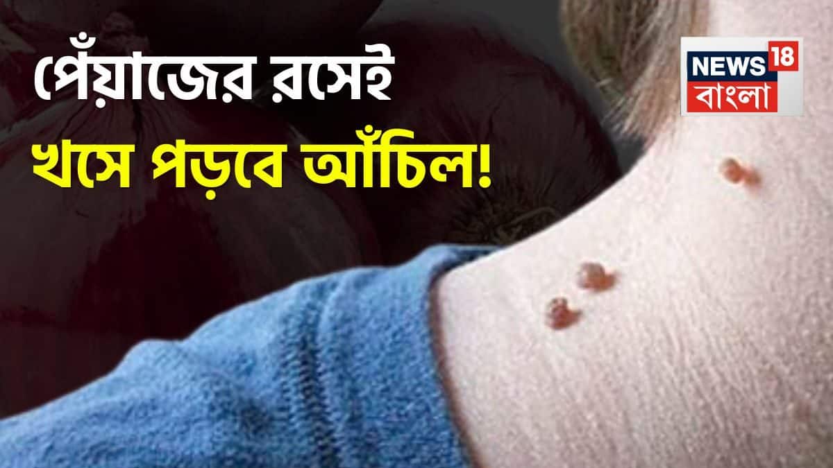 Wart (Anchil) Removing Tips: লাগবে না দামি ওষুধ!পেঁয়াজের রসেই খসে ...