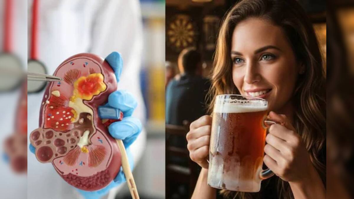 Beer & Kidney Stone: বিয়ার খেলেই গলবে কিডনির পাথর? নাকি মদ্যপানে ...
