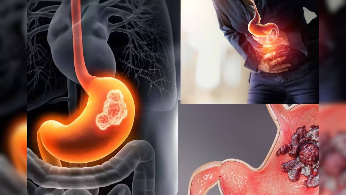 Stomach Cancer & Ulcer: রোজ এই ফল জাস্ট ‘২ টো’! পেটের আলসার, ক্যানসারের ...