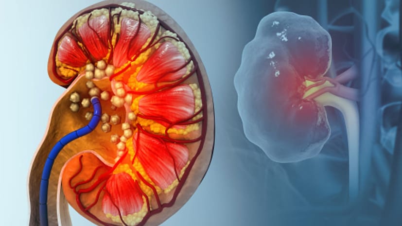 Kidney Disease Warning: ঘনঘন প্রস্রাব বা পা না ফুললেও কিন্তু বিকল হতে ...
