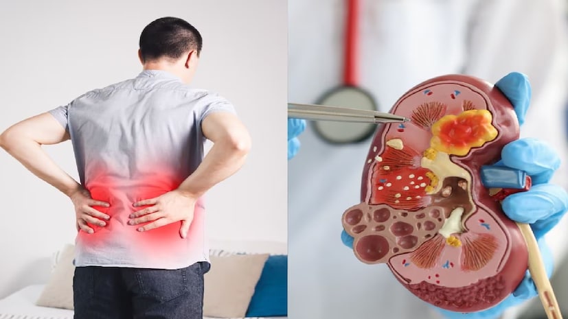 Kidney Disease Warning: ঘনঘন প্রস্রাব বা পা না ফুললেও কিন্তু বিকল হতে ...