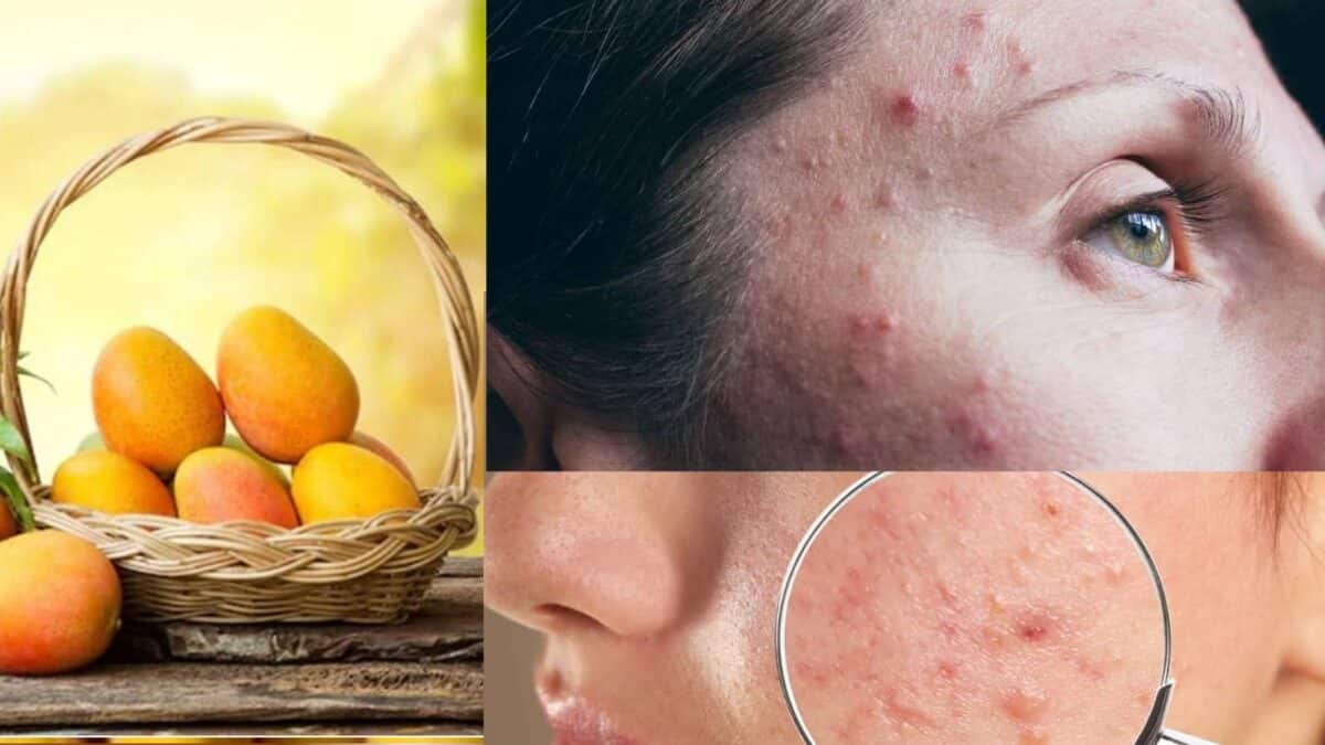 Mango Causes Pimples:পাকা আম খেলে মুখে দগদগে ব্রণ হয়? ক্ষত বিক্ষত ত্বক ...