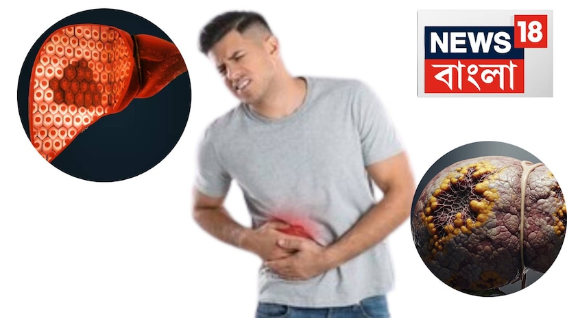 Cirrhosis of Liver Symptoms: সিরোসিস অব লিভারের লক্ষণ কী? শরীরে এই ‘৮ ...