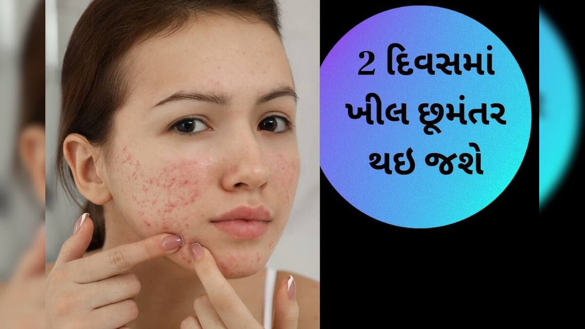 Best home remedies for pimples - રસોડામાં પડેલી આ વસ્તુઓથી ચહેરા પરના ...