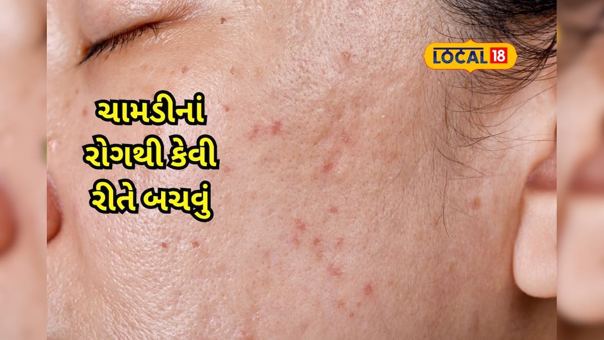 ચામડીના રોગથી બચવાના ઉપાય - Latest news in Gujarati : Remedy for skin ...