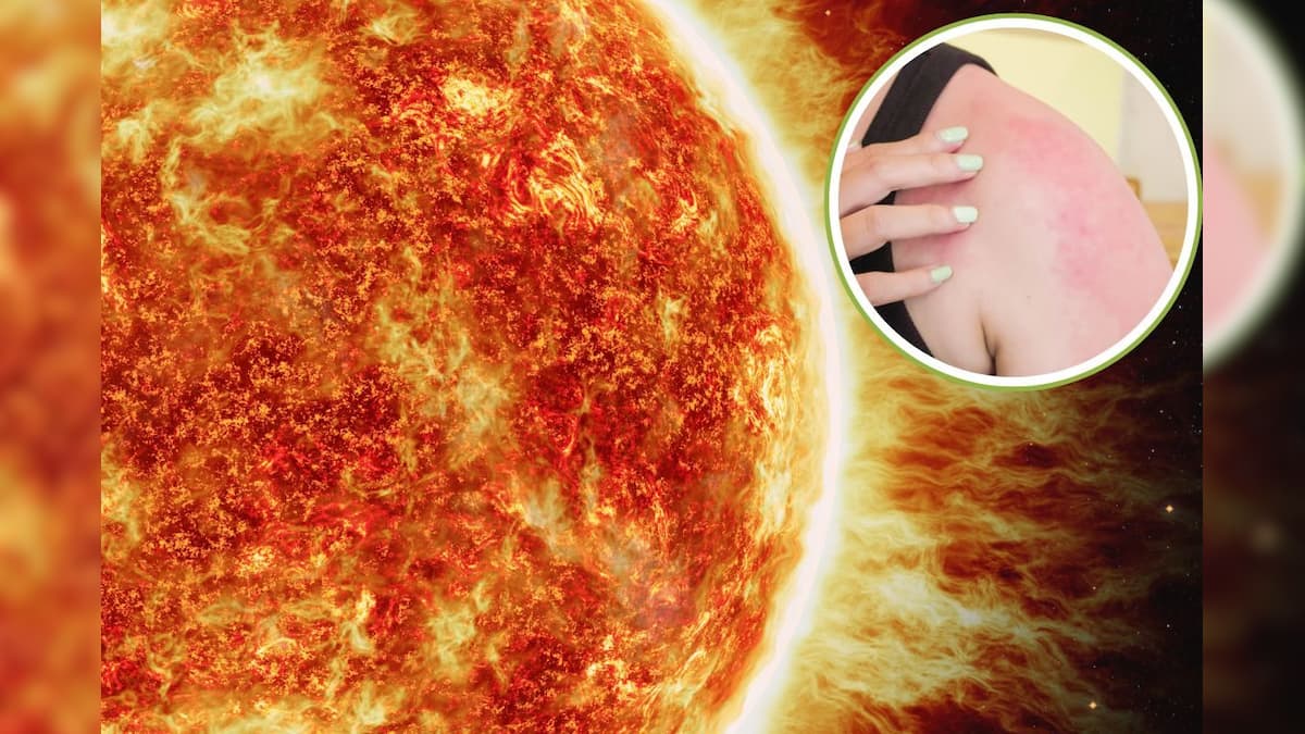 Know the real reason of sunburn effect from Space Tutor Tanmay Vyas ...