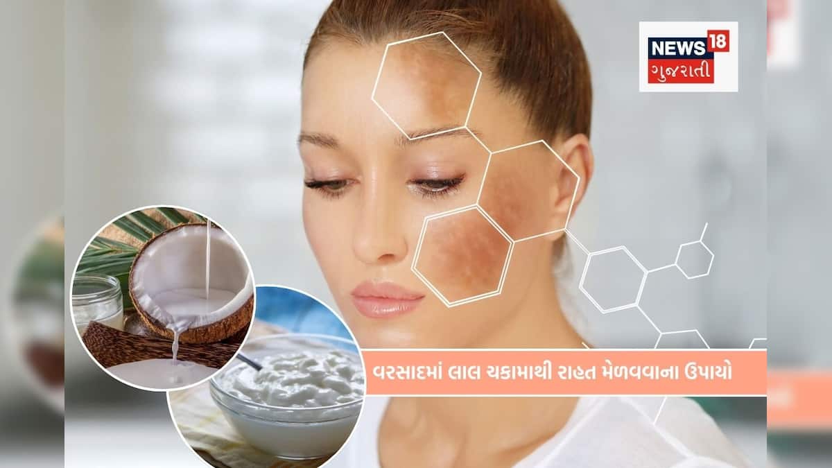 વરસાદી પાણીથી ચામડી પર ચકામા પડી જાય છે? તો આ 4 ઉપચાર આપશે ઝટપટ રાહત ...