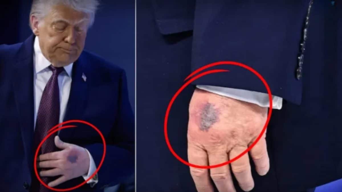 ડોનાલ્ડ ટ્રમ્પના ડાબા હાથમાં દેખાયો મોટો કાળો ડાઘ, શું US રાષ્ટ્રપતિને ...