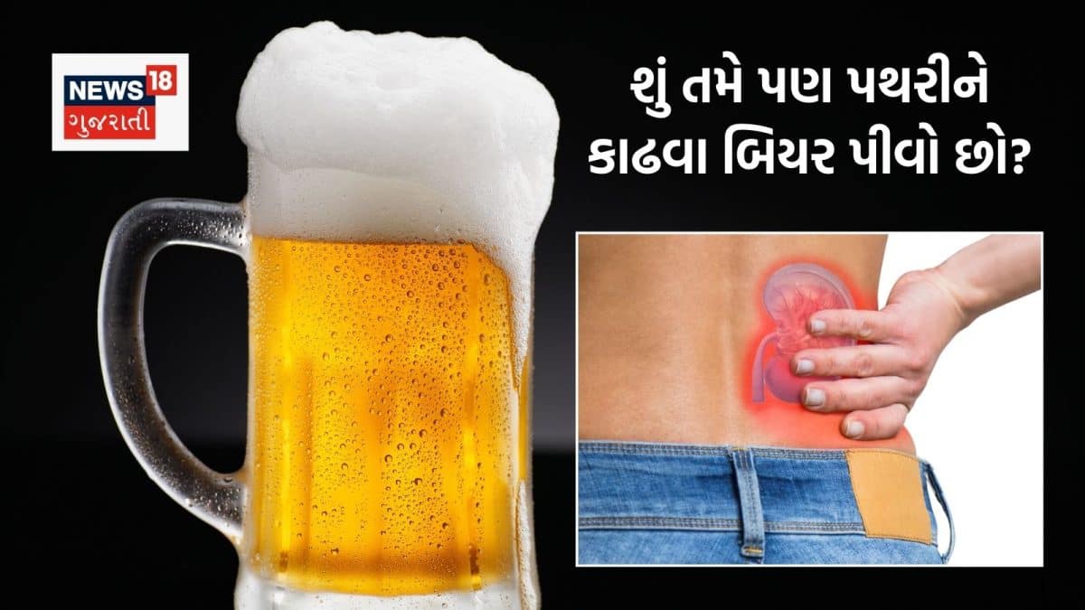 કિડનીમાં પથરી છે? તો બિયર ચાલુ કરી દો, જાણો આ વાતમાં કેટલું તથ્ય છે ...