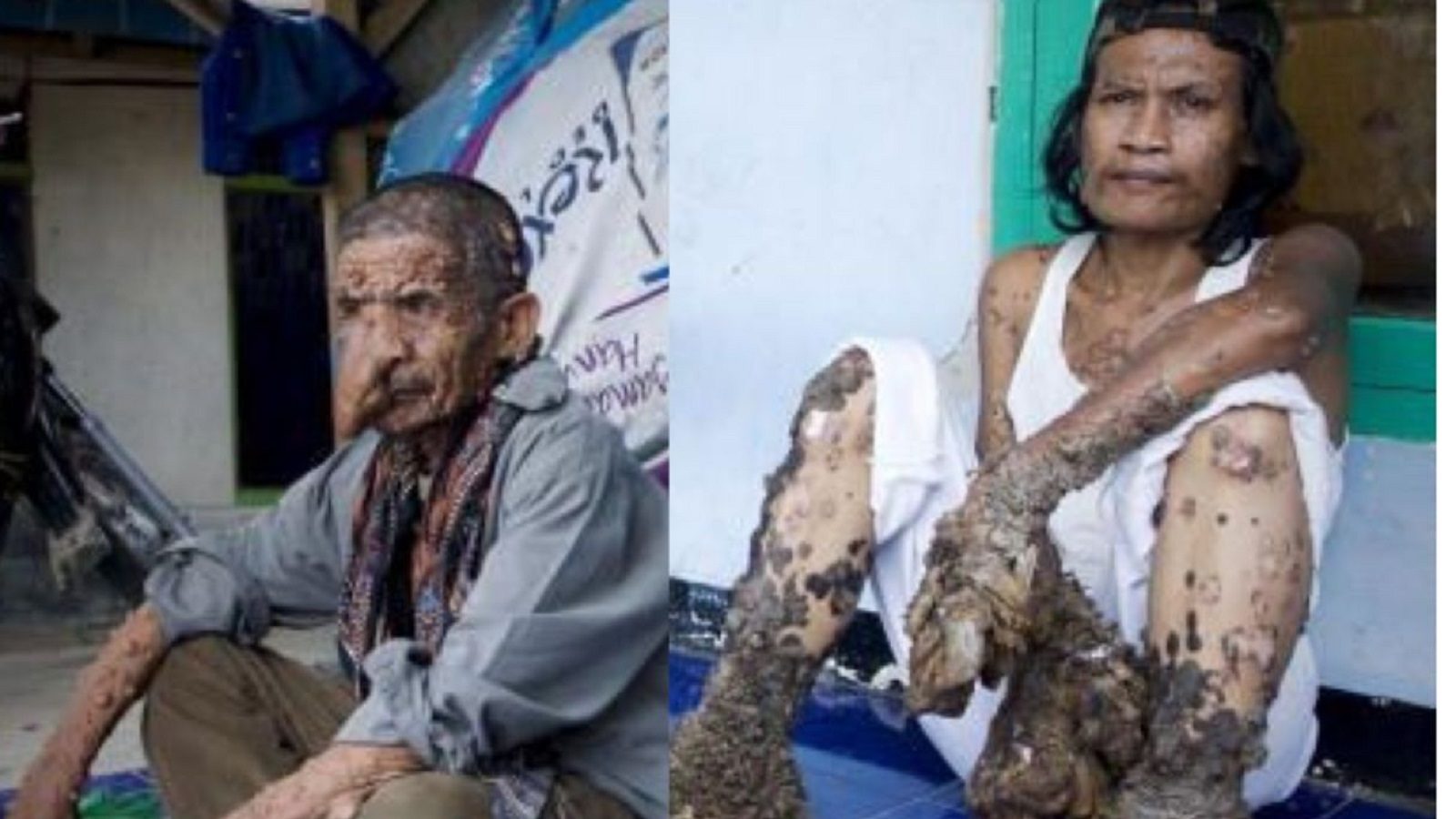 Know about tree man syndrome symptoms treatment of rare diseases which ...