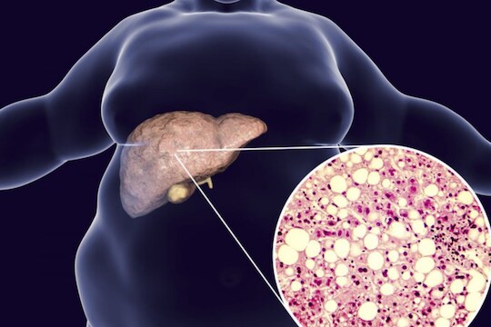 'டயாபடிக் லிவர் பாதிப்பு’ என்றால் என்ன..? இதன் 5 முக்கிய அறிகுறிகளை ...