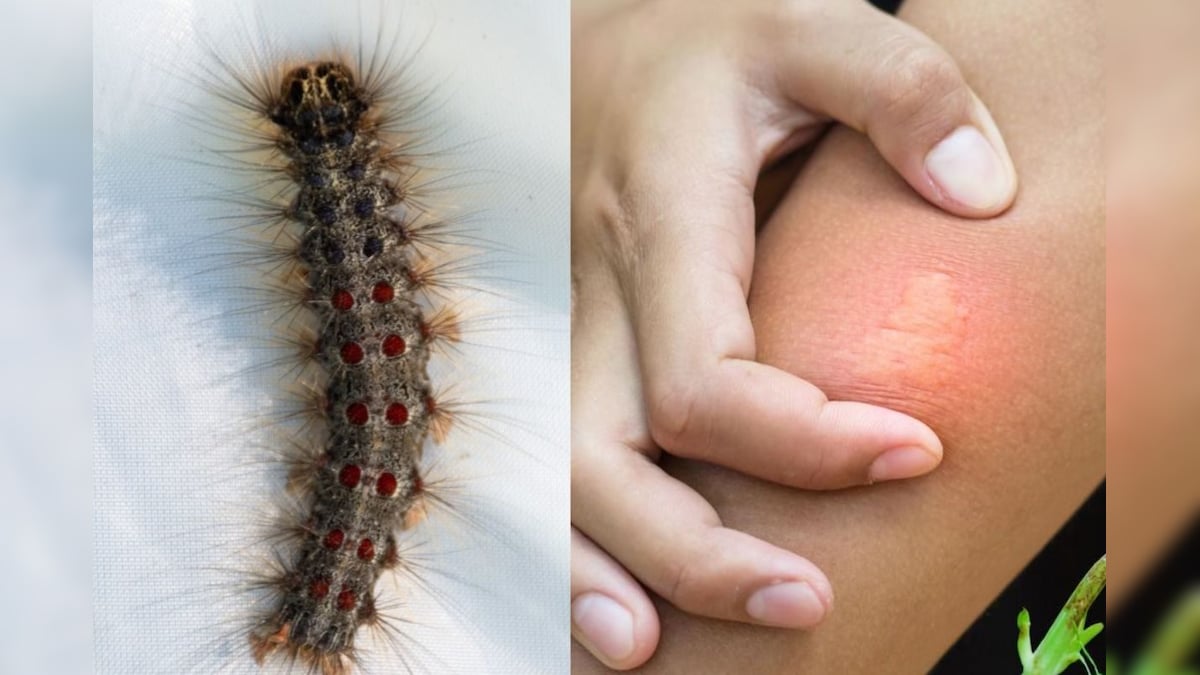 Caterpillar Sting Remedies: கம்பளிப்பூச்சி கடித்தால் உடனே என்ன செய்ய ...