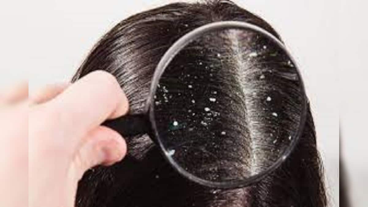 Dandruff removal: డాండ్రఫ్ సమస్య ఎక్కువగా ఉంటుందా? అయితే ఈ చిట్కాలతో ...
