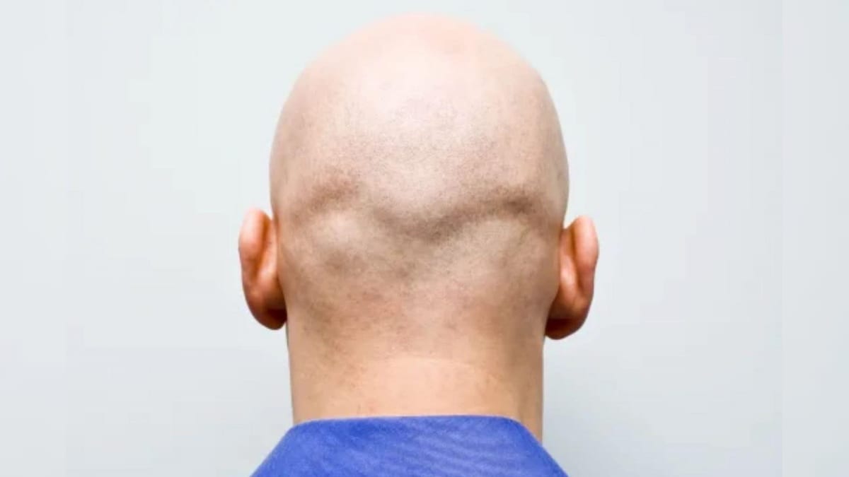 Baldhead: బట్టతలకు మందొచ్చిందోచ్..! ఇక బాల్డ్ హెడ్ పై కూడా వెంట్రుకలు ...