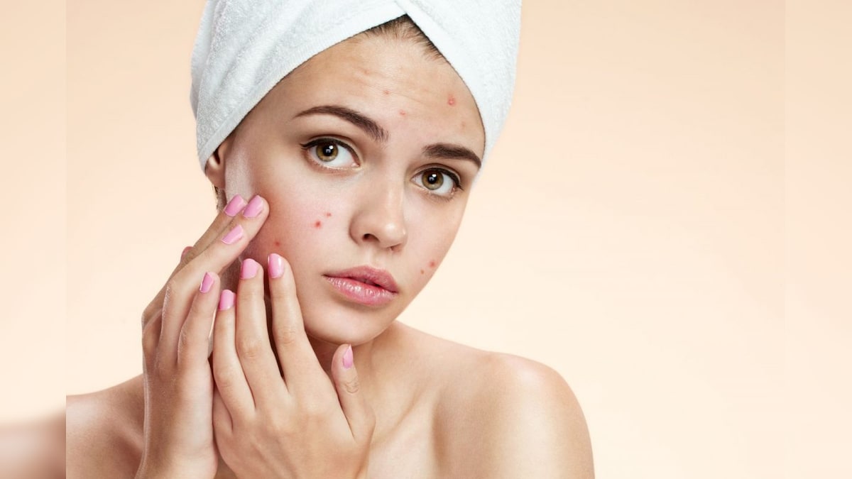 Remove pimples: మొటిమలు పోవాలంటే.. ముల్తానీ మిట్టిలో తేనె కలిపి ఇలా ...