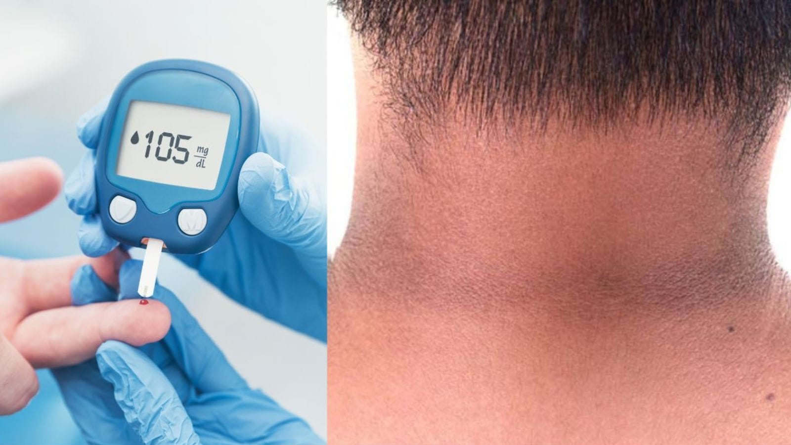 Diabetes Symptoms: మెడ చుట్టూ నల్లగా ఉంటే షుగర్ వ్యాధి సంకేతమా ...