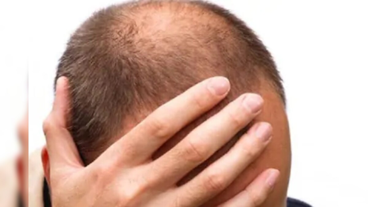 Bald Head: ఆడవారికి రాని బట్టతల మగవారికే ఎందుకొస్తుంది? ఇదే కారణం ...