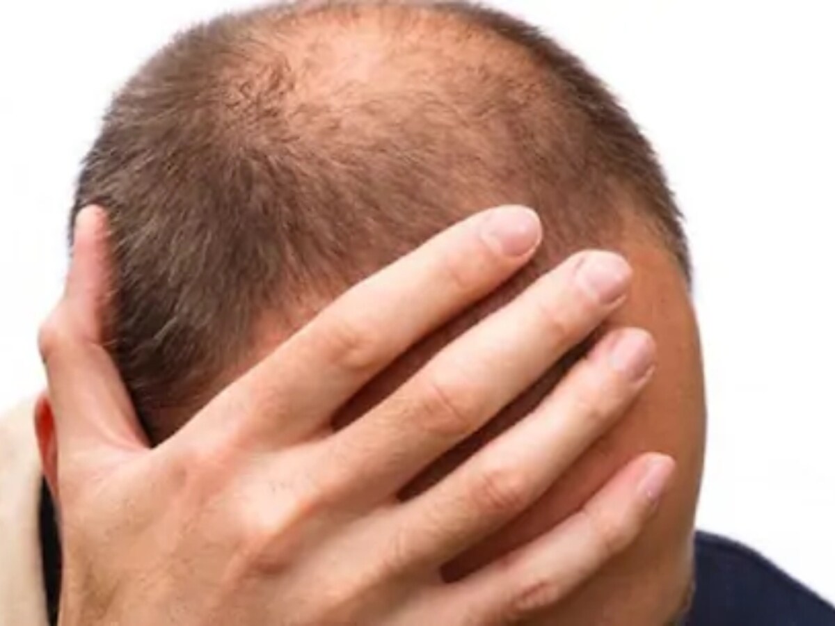 Bald Head: ఆడవారికి రాని బట్టతల మగవారికే ఎందుకొస్తుంది? ఇదే కారణం ...
