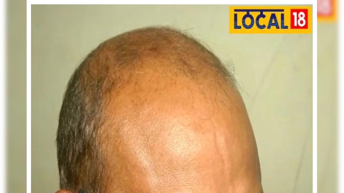 Bald Head : బట్టతల వస్తుందని భయపడుతున్నారా.. అయితే ఈ మెడికల్ కాలేజీలో ...