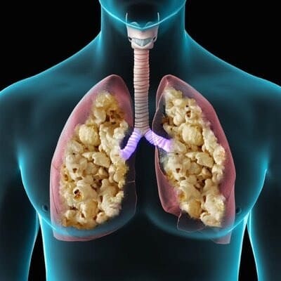 Popcorn Lung Signs: కఫం లేకుండా దగ్గు వస్తోందా? ఈ వ్యాధికి సంకేతం ...